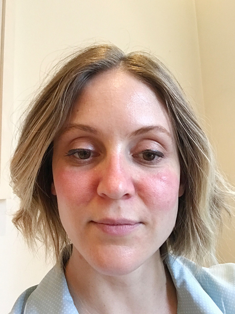 What Is It Like To Get A Laser Facial - Excel V Review